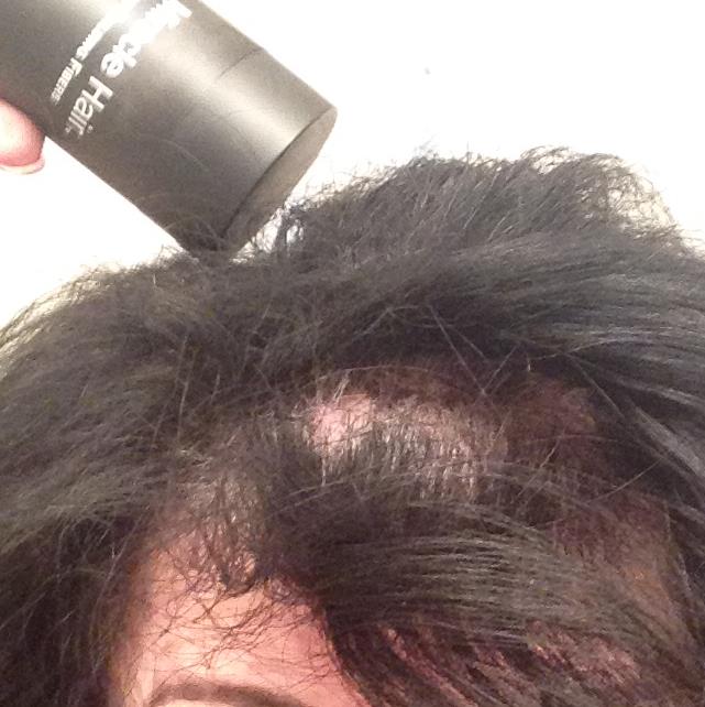 My Hair Lady–The Bald and the Beautiful! | Atypical 60